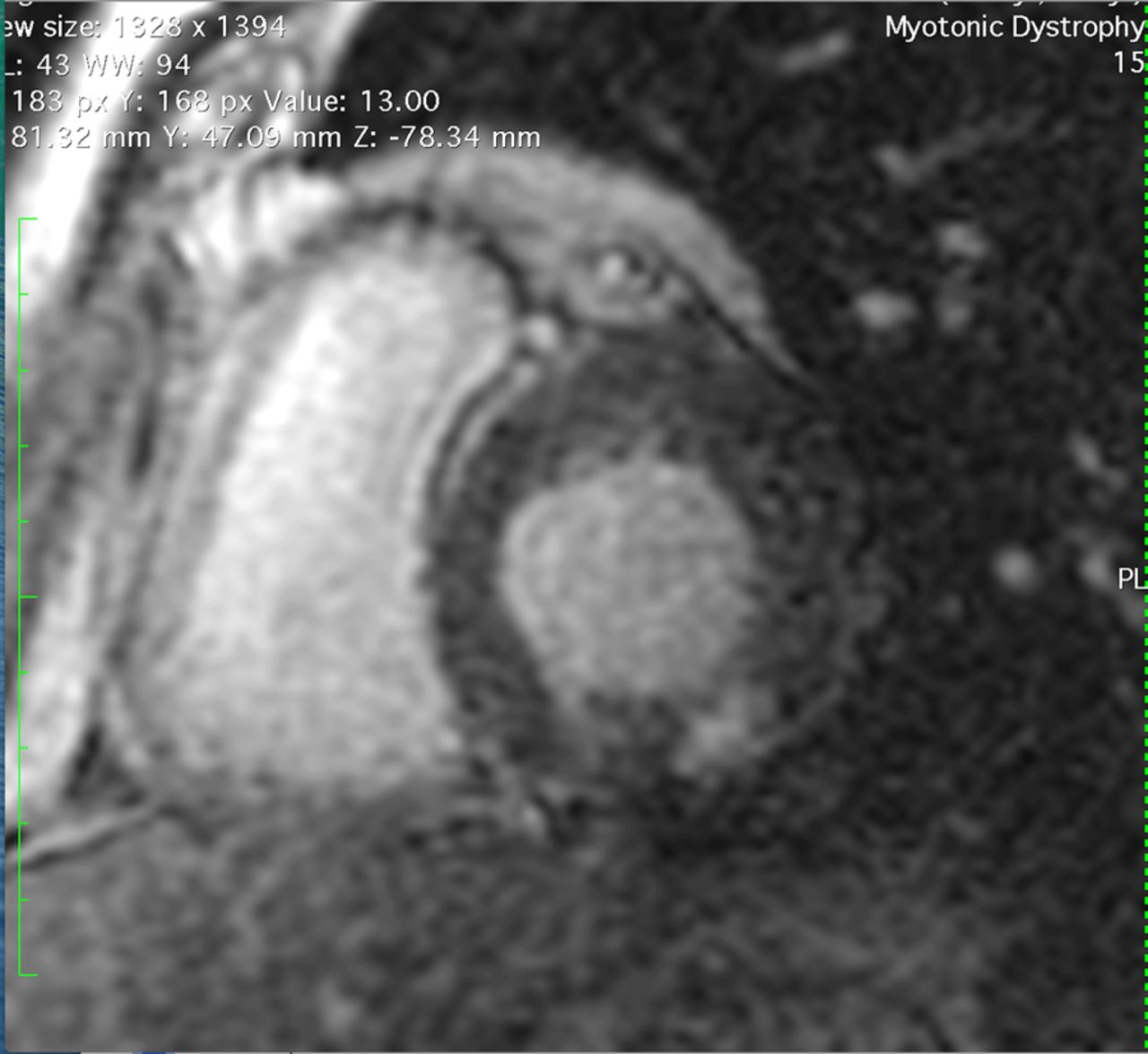 Structural and electrical cardiac abnormalities are prevalent in ...