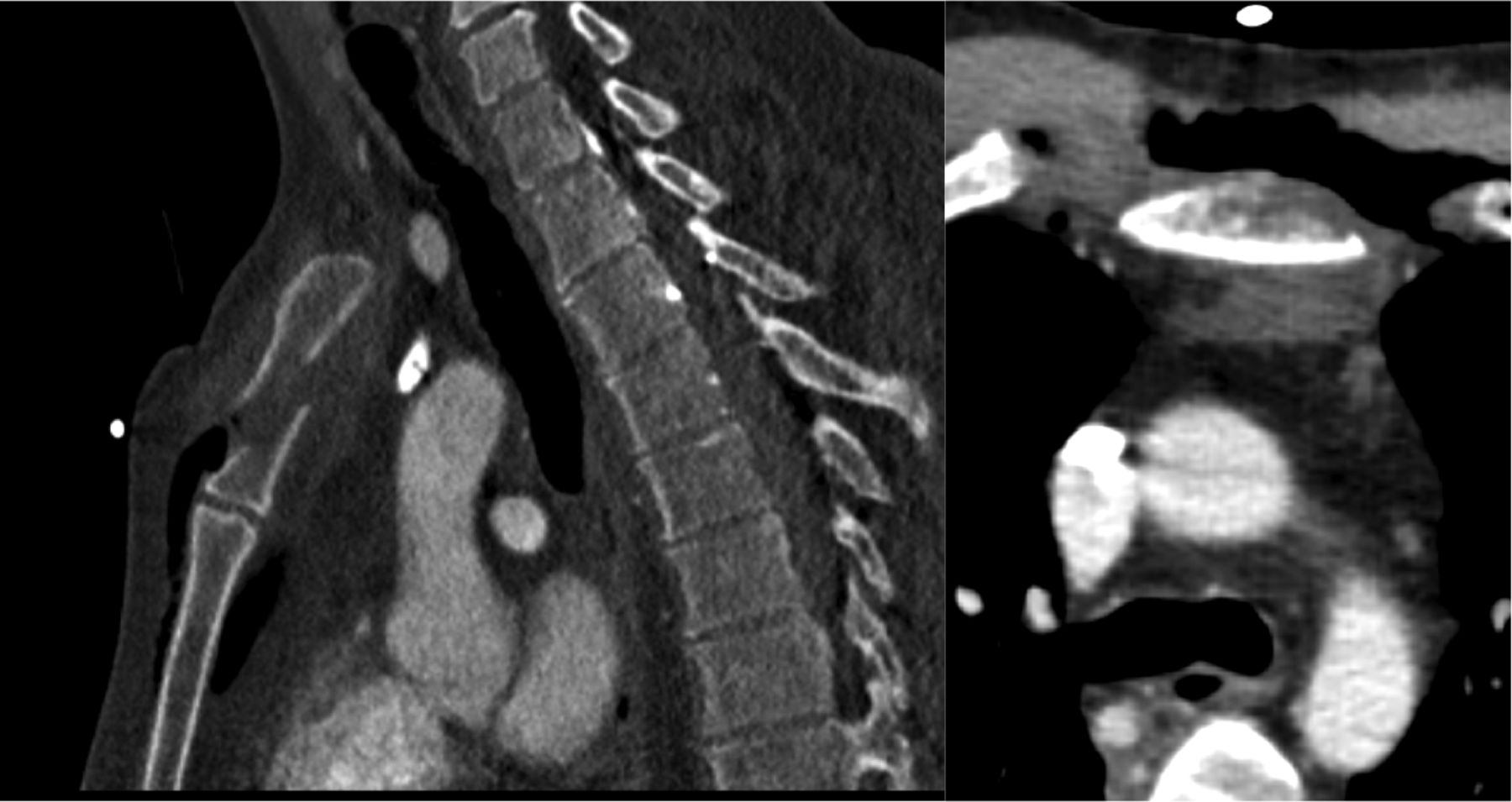 Blunt chest trauma: a clinical chameleon | Heart