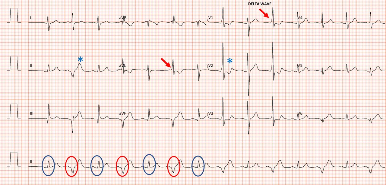 Woman with alternating QRS in the emergency department: what is ...