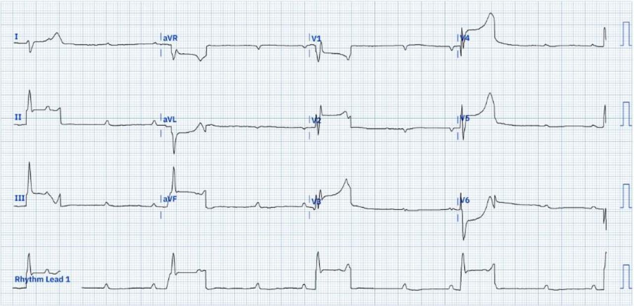 St Segment Elevation File:Normal ST Elevation.png ECGpedia