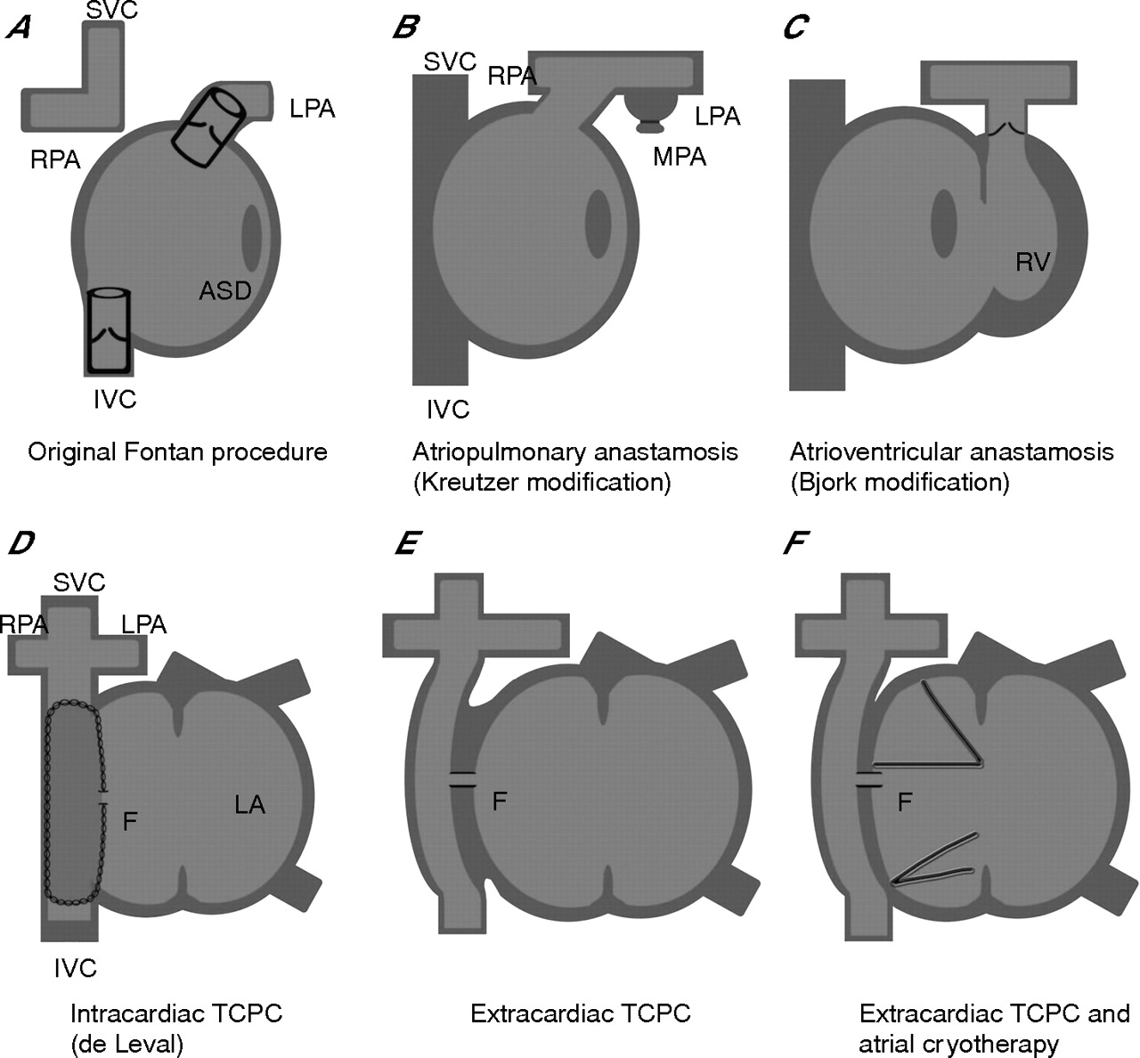 Pregnancy and the various forms of the Fontan circulation | Heart