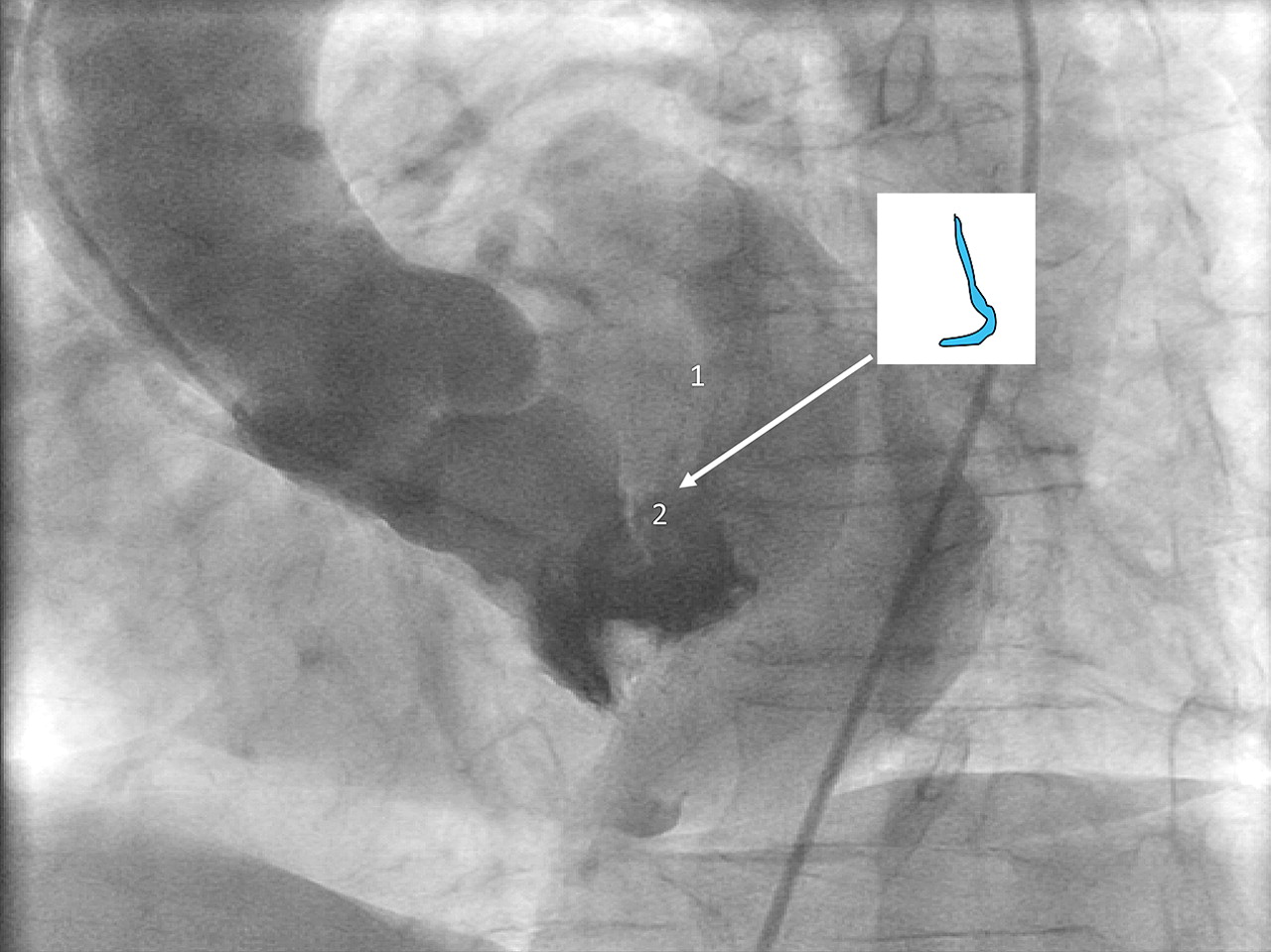 The patient with hypertrophic cardiomyopathy | Heart