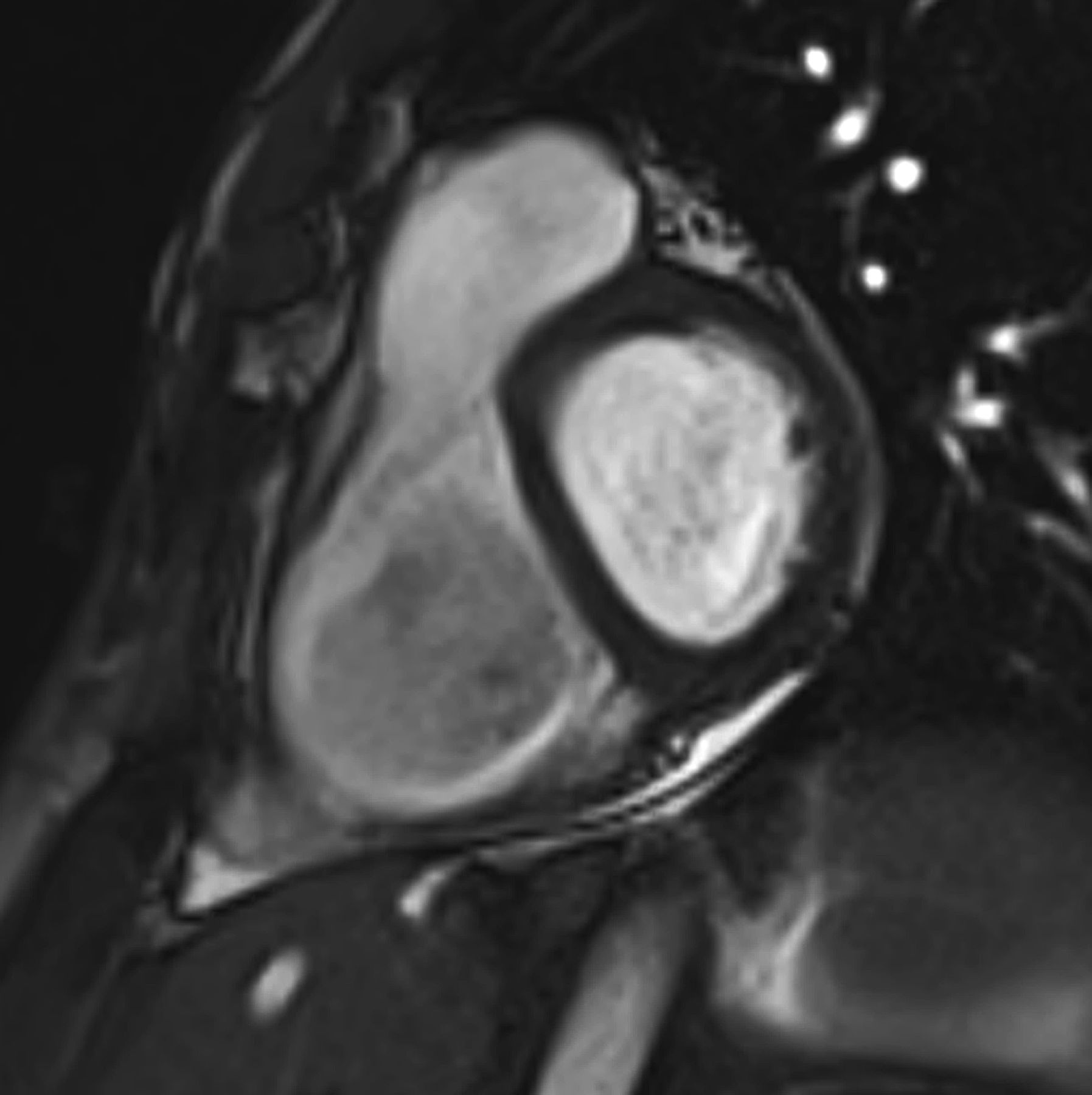 Diagnosis of right atrial myxoma by cardiac MRI: an unexpected ...