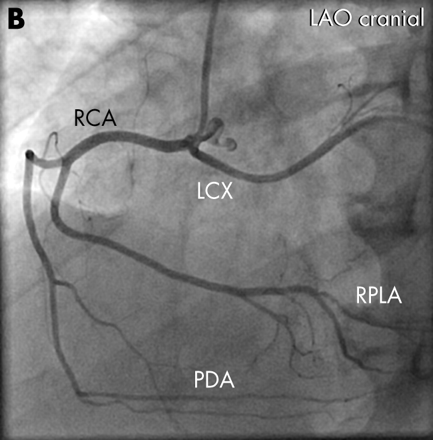 Separate anomalous origin of the left anterior descending artery and ...